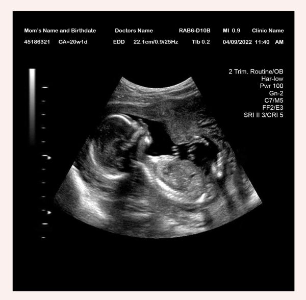 19 Week Ultrasound - Ultrasounds
