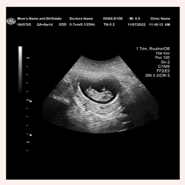 7 Week Ultrasound - Ultrasounds