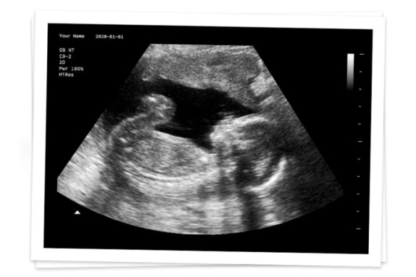 Custom Fake Ultrasound Online - Ultrasounds1