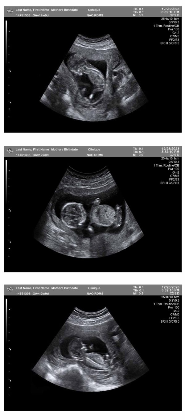 12 Weeks Sonogram - Ultrasounds