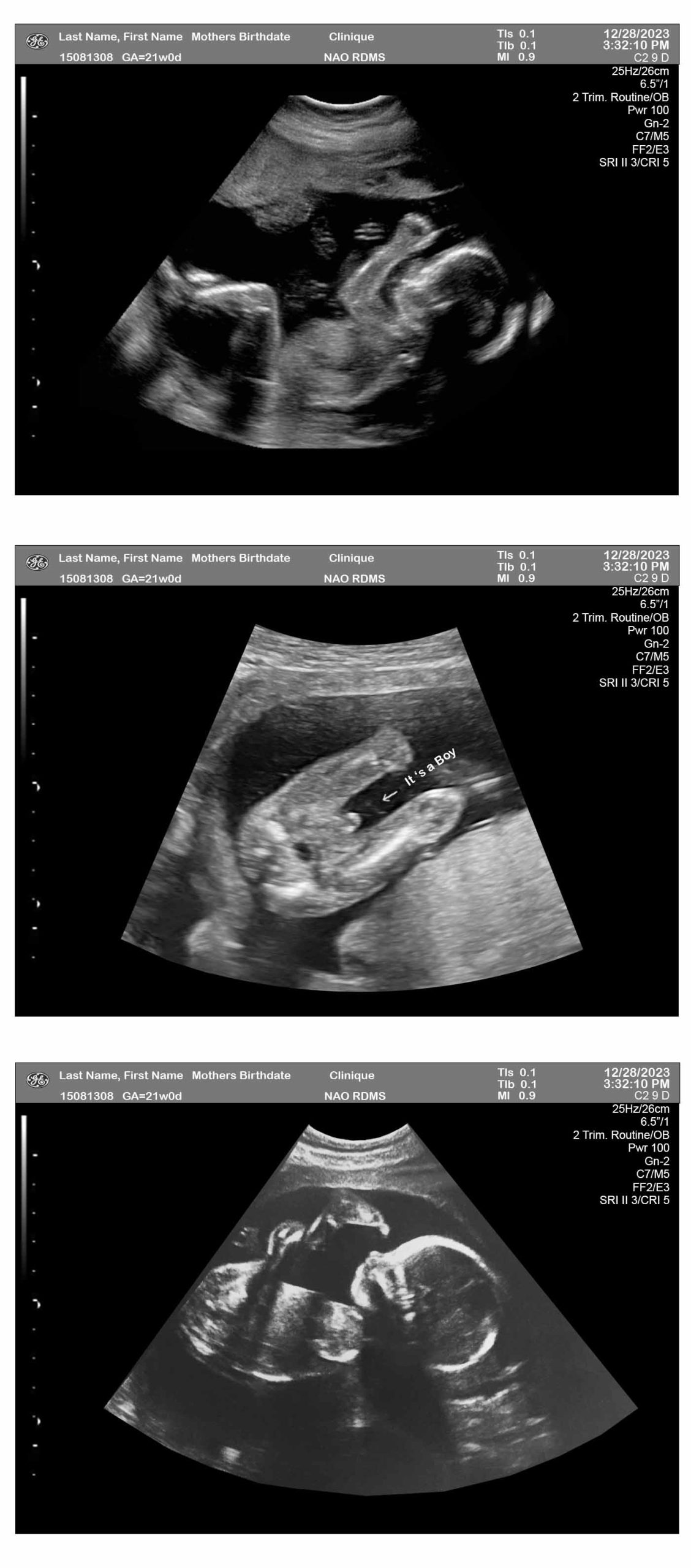 3-Fetuses 21 Weeks Ultrasound: Boy - Ultrasounds