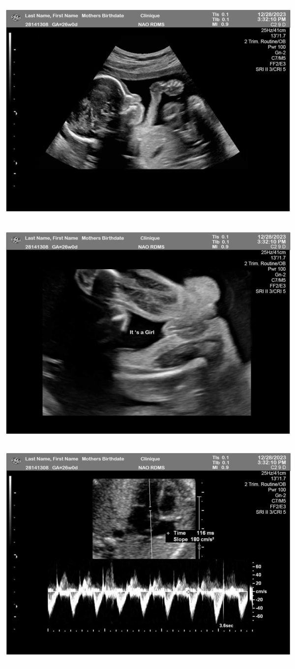 3-Fetuses 26 Weeks Ultrasound Girl - Ultrasounds