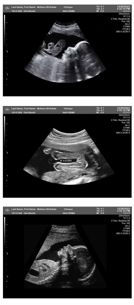 3-Fetuses 28 Weeks Ultrasound Girl - Ultrasounds