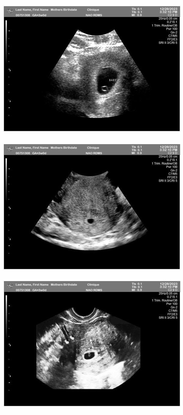 3-Fetuses 3 Weeks Ultrasound - Ultrasounds